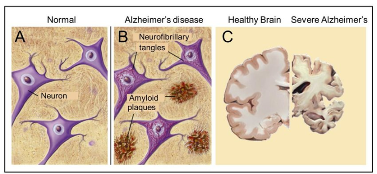 Pengujian ELISA β-amyloid (Aβ) Untuk Deteksi Penyakit Alzheimer - PT ...